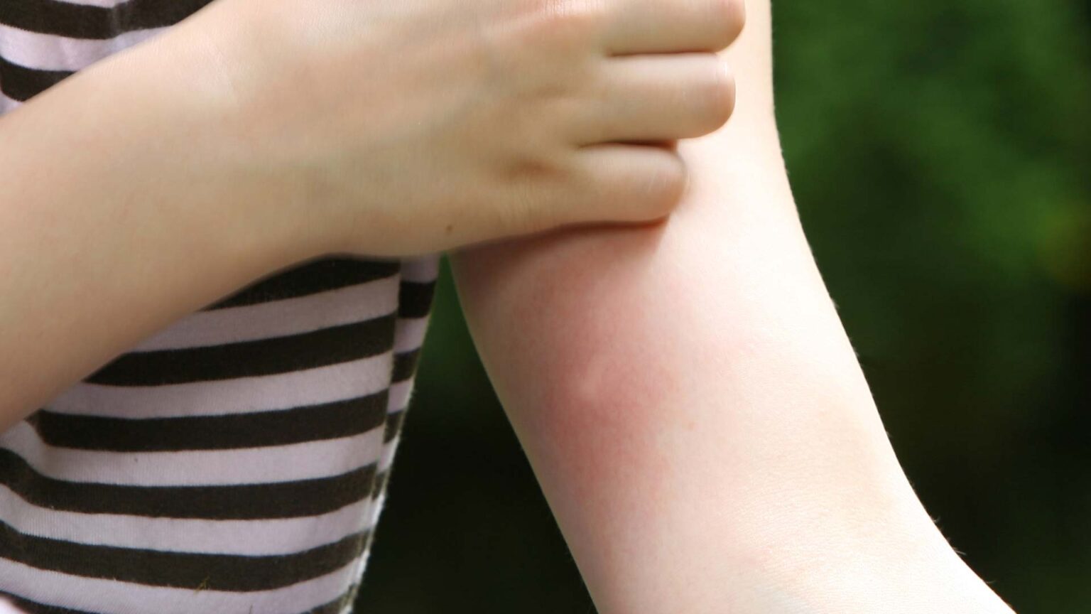 How To Tell Spider Bites Vs Mosquito Bites